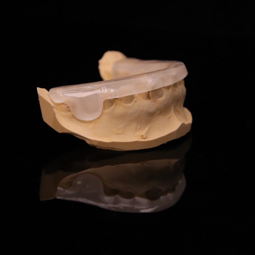 Occlusal splint – China Dental Lab-Dental Laboratory in China